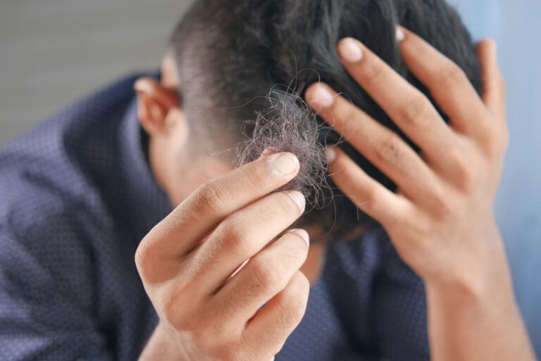 Topical dutasteride for severe hair loss